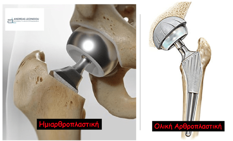 Κάταγμα Ισχίου: Συμπτώματα & Θεραπεία - Α. Λεωνίδου